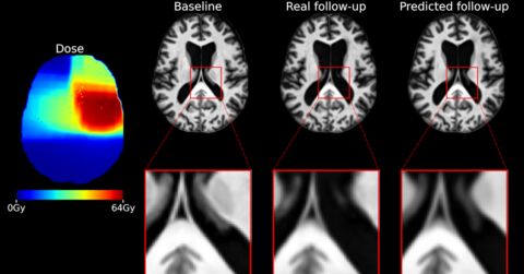 AI will soon predict how brains change after radiotherapy for brain tumors